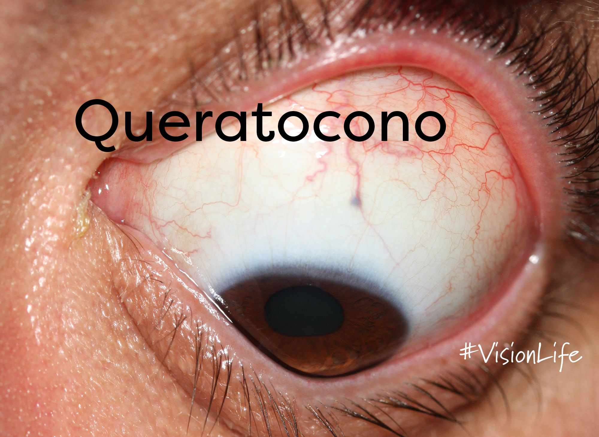 Queratocono | Vision LIFE